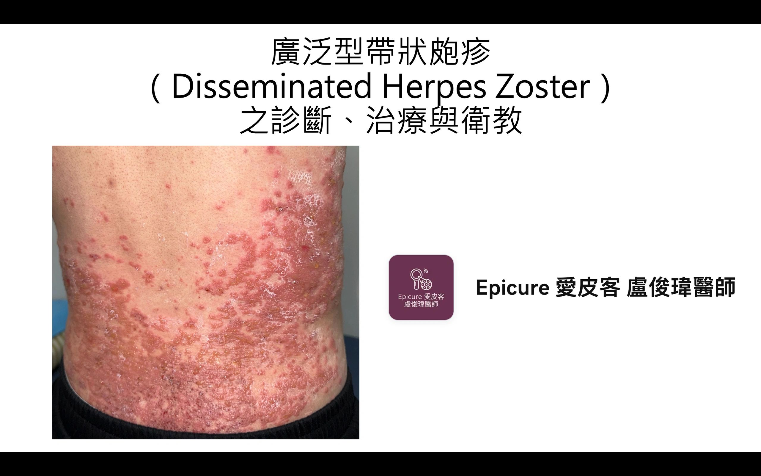 廣泛型帶狀皰疹（Disseminated Herpes Zoster）之診斷、治療與衛教