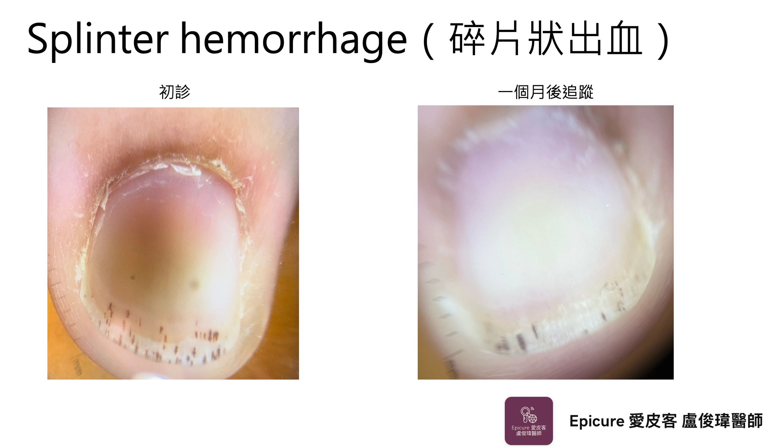 指甲的黑線需要擔心嗎？從一位病人的經驗談Splinter hemorrhage