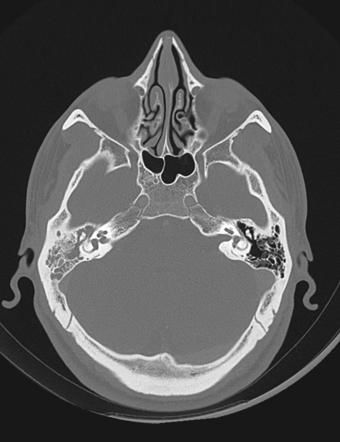Mastoiditis Mri
