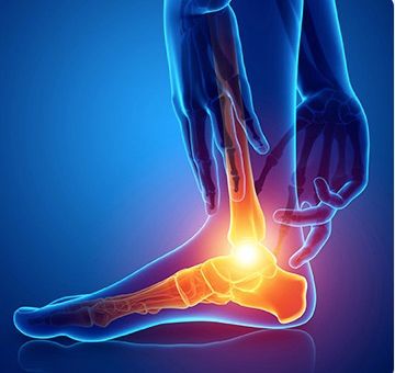 Calcaneal Apophysitis