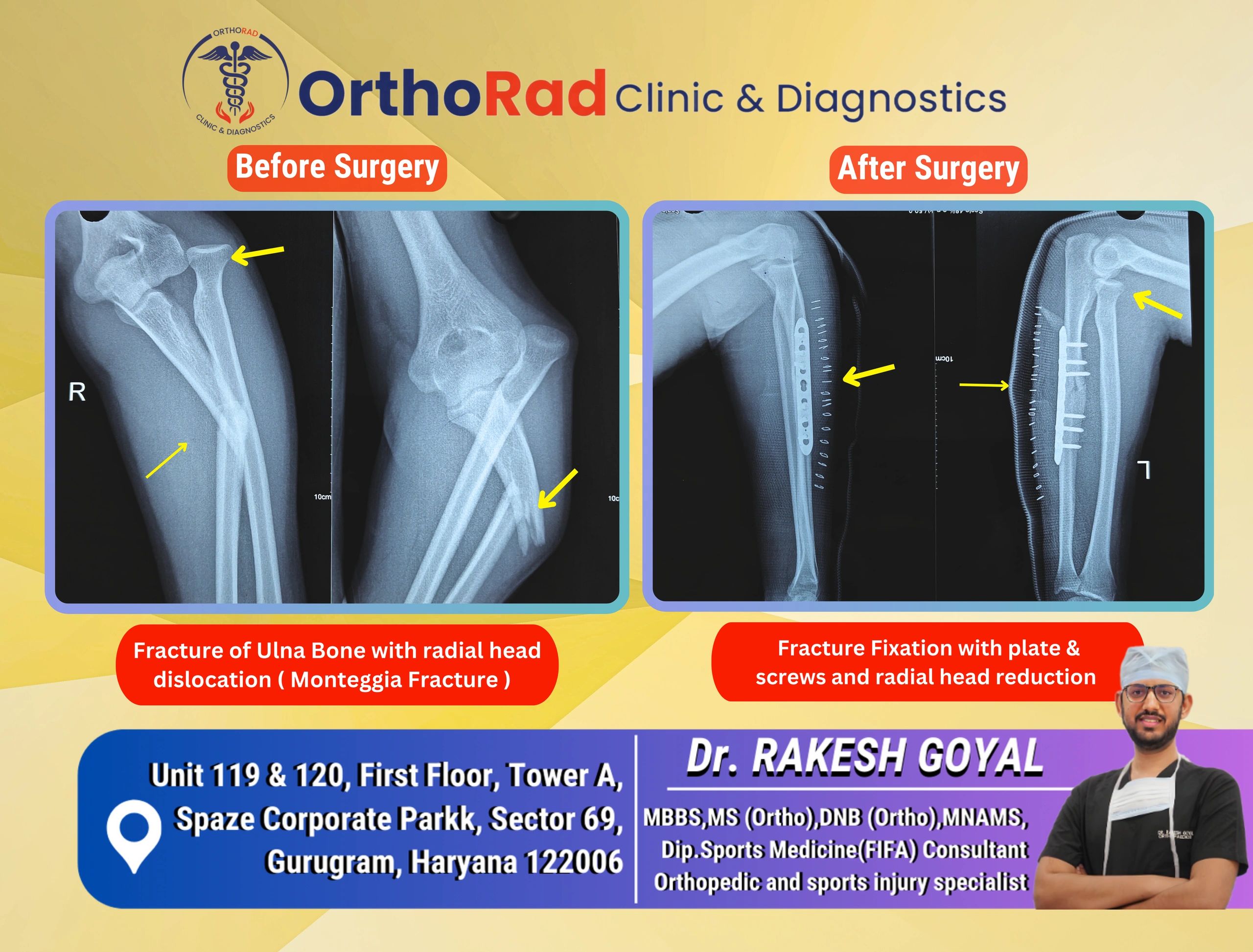 Forearm fracture treatment