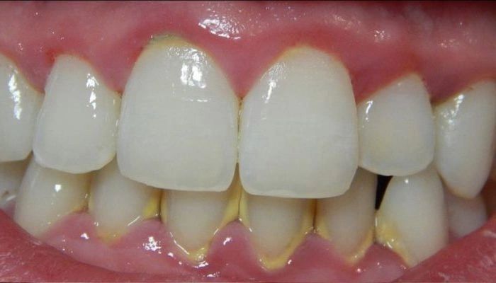 Tartre dentaire: Un facteur de risques