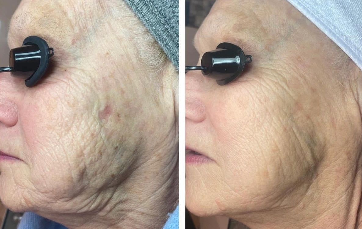 SWiCH Dermal Rejuvenation