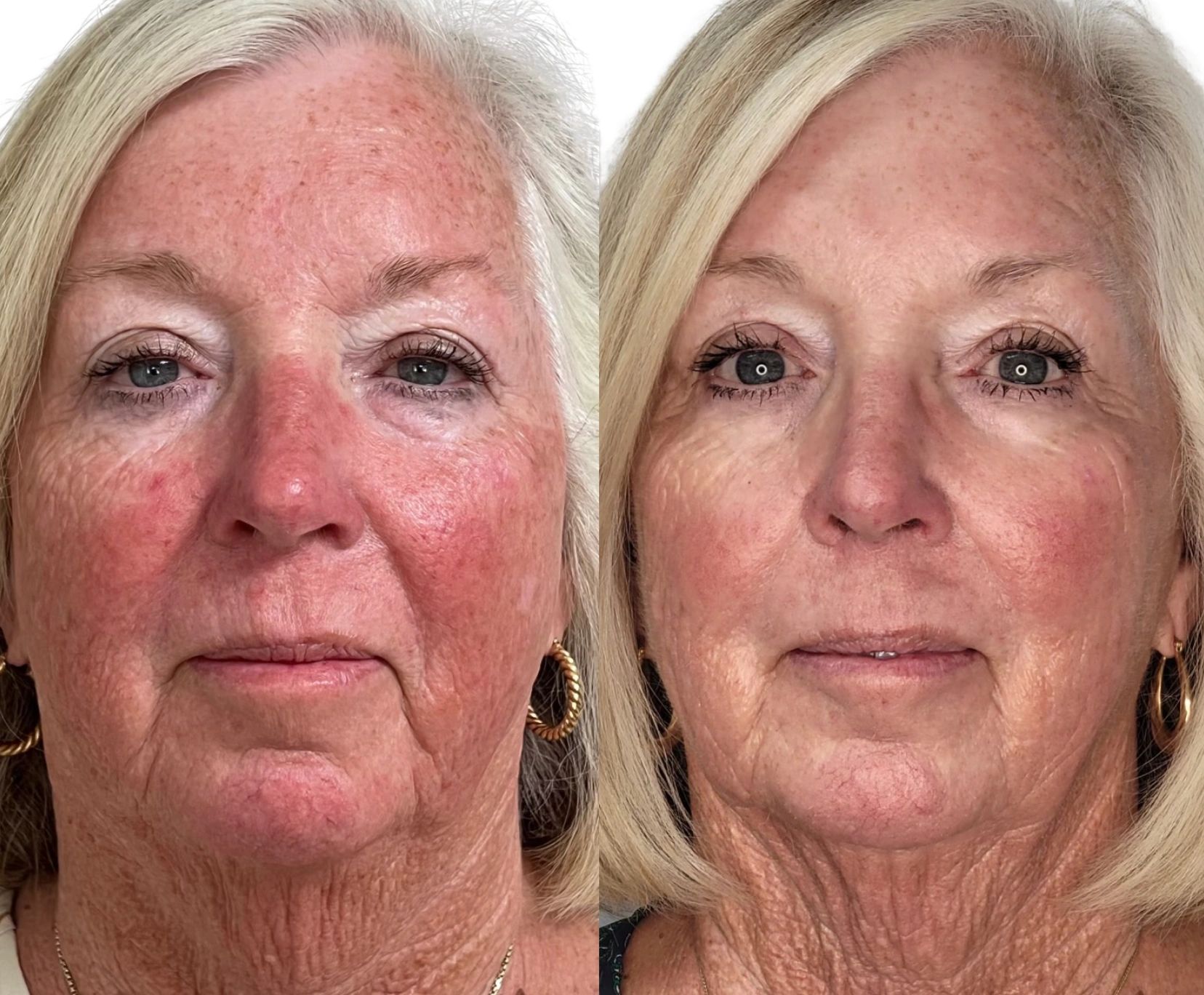 Understanding NeoGen Skin Tightening and the Gradual Results