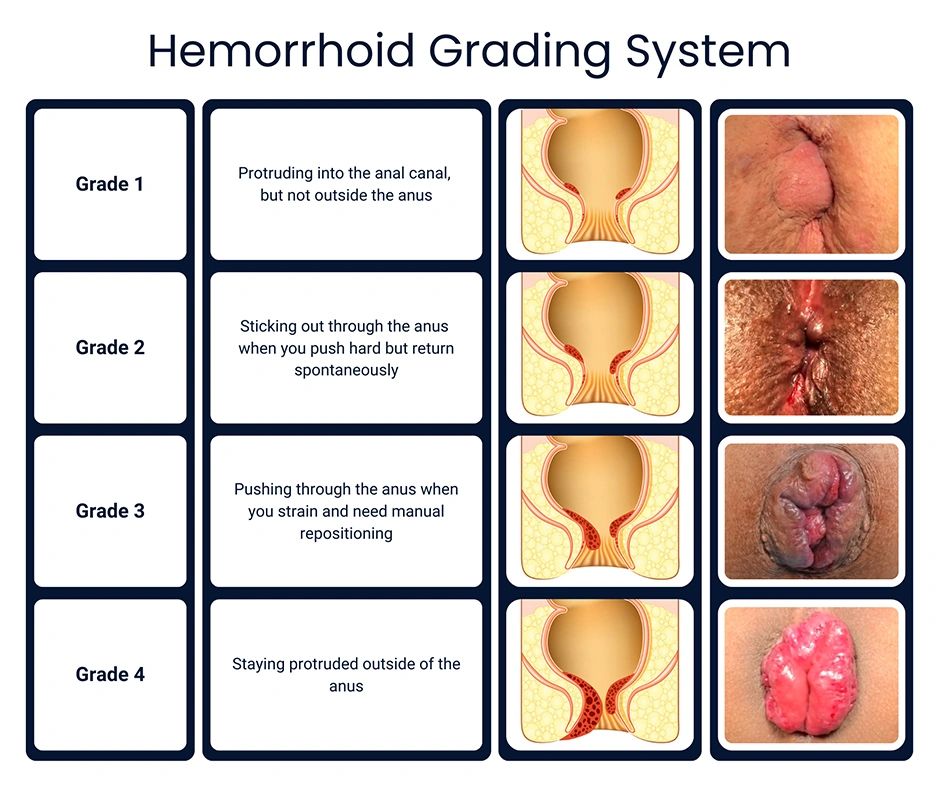 Prolapsed Internal Hemorrhoid