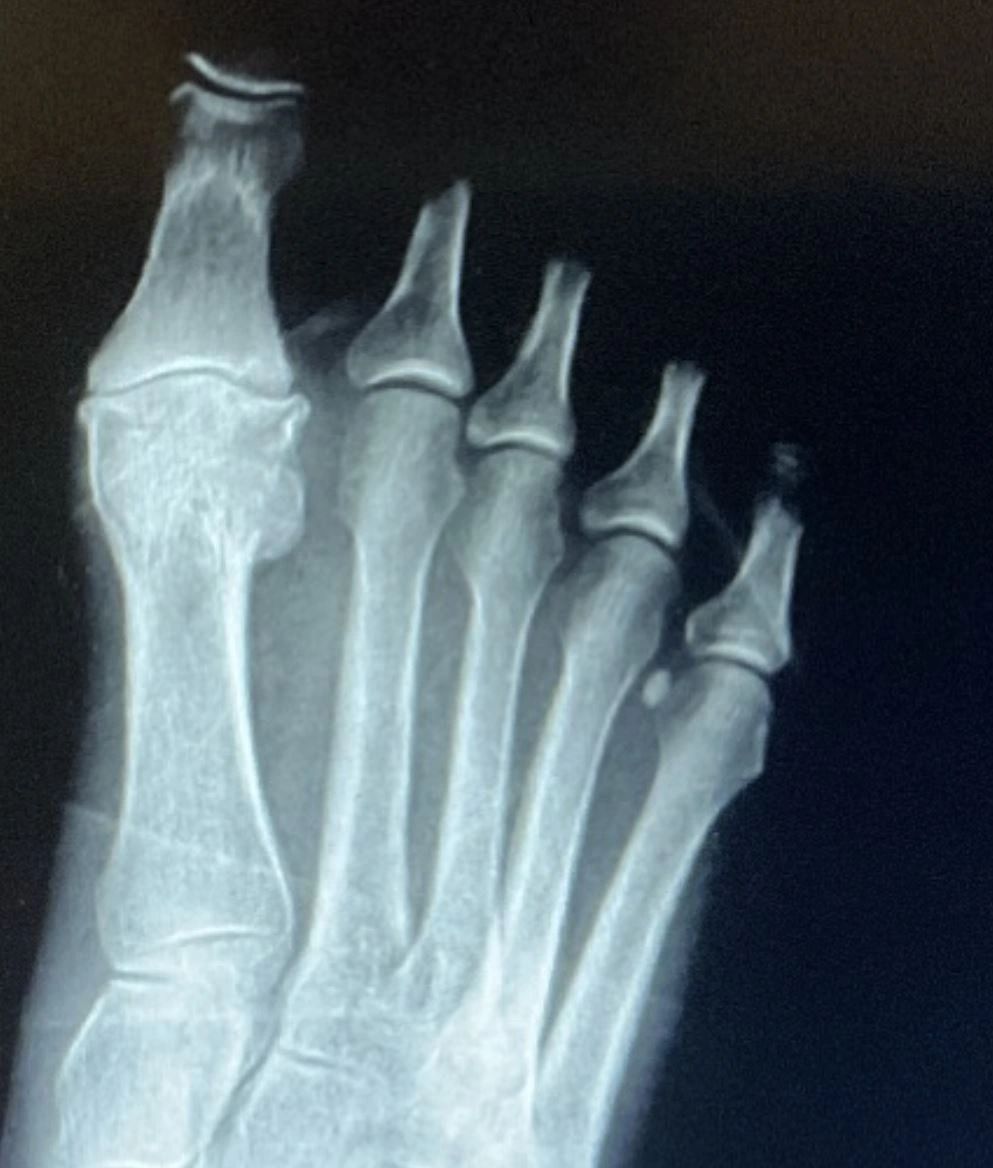 All About Hallux Rigidus