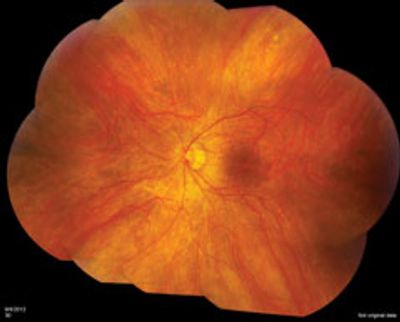 AUTOIMMUNE RETINOPATHY: THE RETINA INSTITUTE BOARD CERTIFIED RETINAL ...