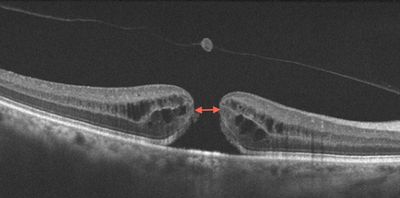 MACULAR HOLE: THE RETINA INSTITUTE BOARD CERTIFIED RETINAL MICRO ...