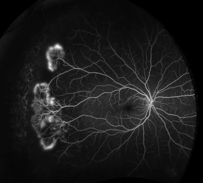 SICKLE CELL RETINOPATHY: THE RETINA INSTITUTE BOARD CERTIFIED RETINAL ...