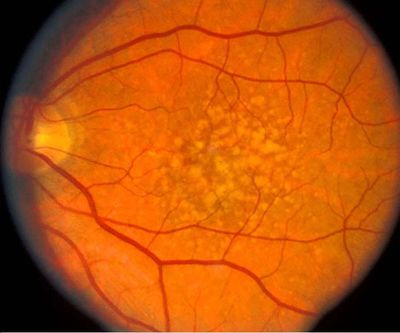 MACULAR DEGENERATION: THE RETINA INSTITUTE BOARD CERTIFIED RETINAL ...