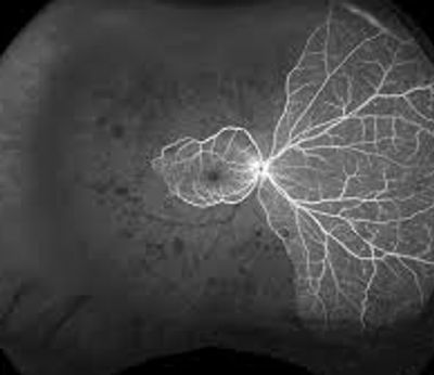 OCULAR ISCHEMIC SYNDROME: THE RETINA INSTITUTE BOARD CERTIFIED RETINAL ...