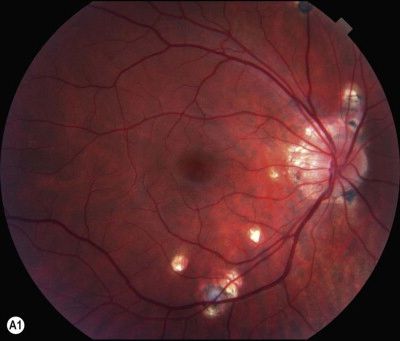 Ocular Histoplasmosis