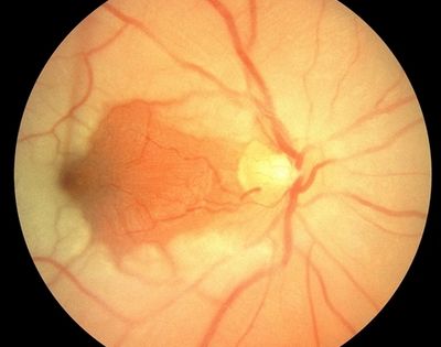 RETINAL ARTERY OCCLUSION: THE RETINA INSTITUTE BOARD CERTIFIED RETINAL ...