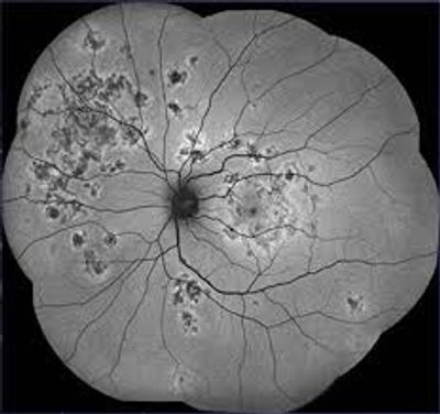 WHITE DOT SYNDROMES