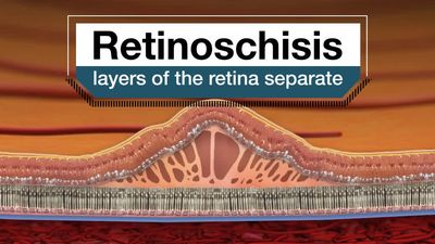 RETINOSCHISIS: THE RETINA INSTITUTE BOARD CERTIFIED RETINAL MICRO ...