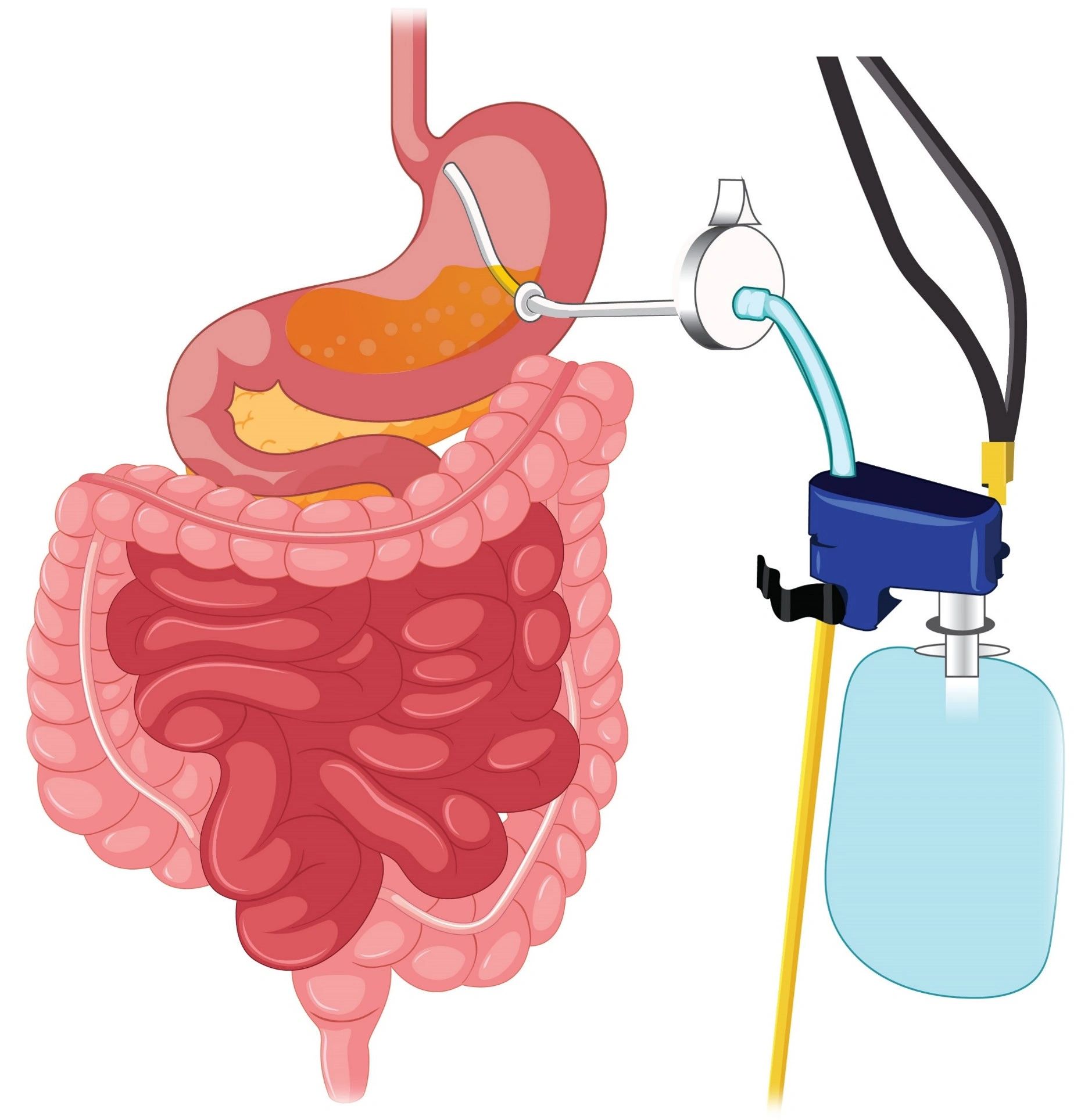 Aspire Assist® Device: Rest in Peace