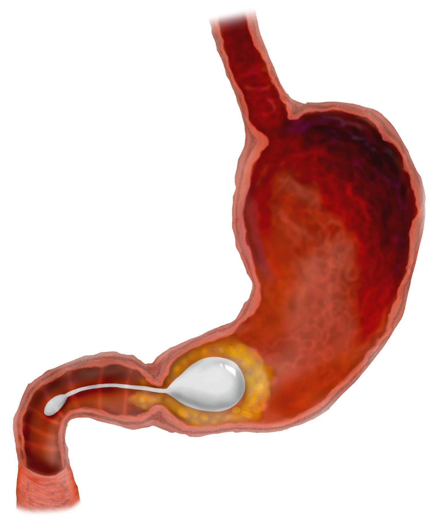 TransPyloric Shuttle®: Creative, but Limited Indications