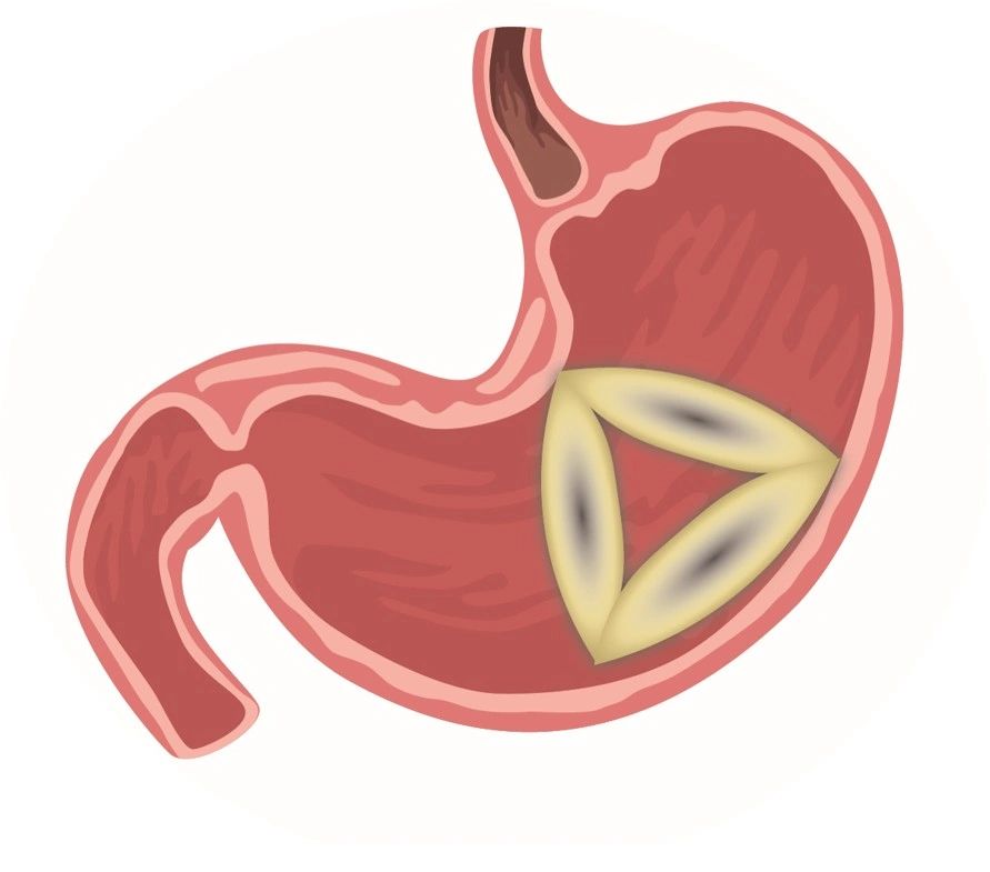 Epitomee®: A Novel FDA-Cleared Device