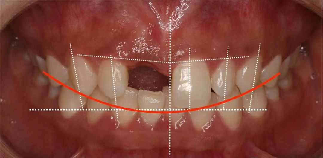 Immediate DSD Aesthetic Restoration of Anterior Teeth Case