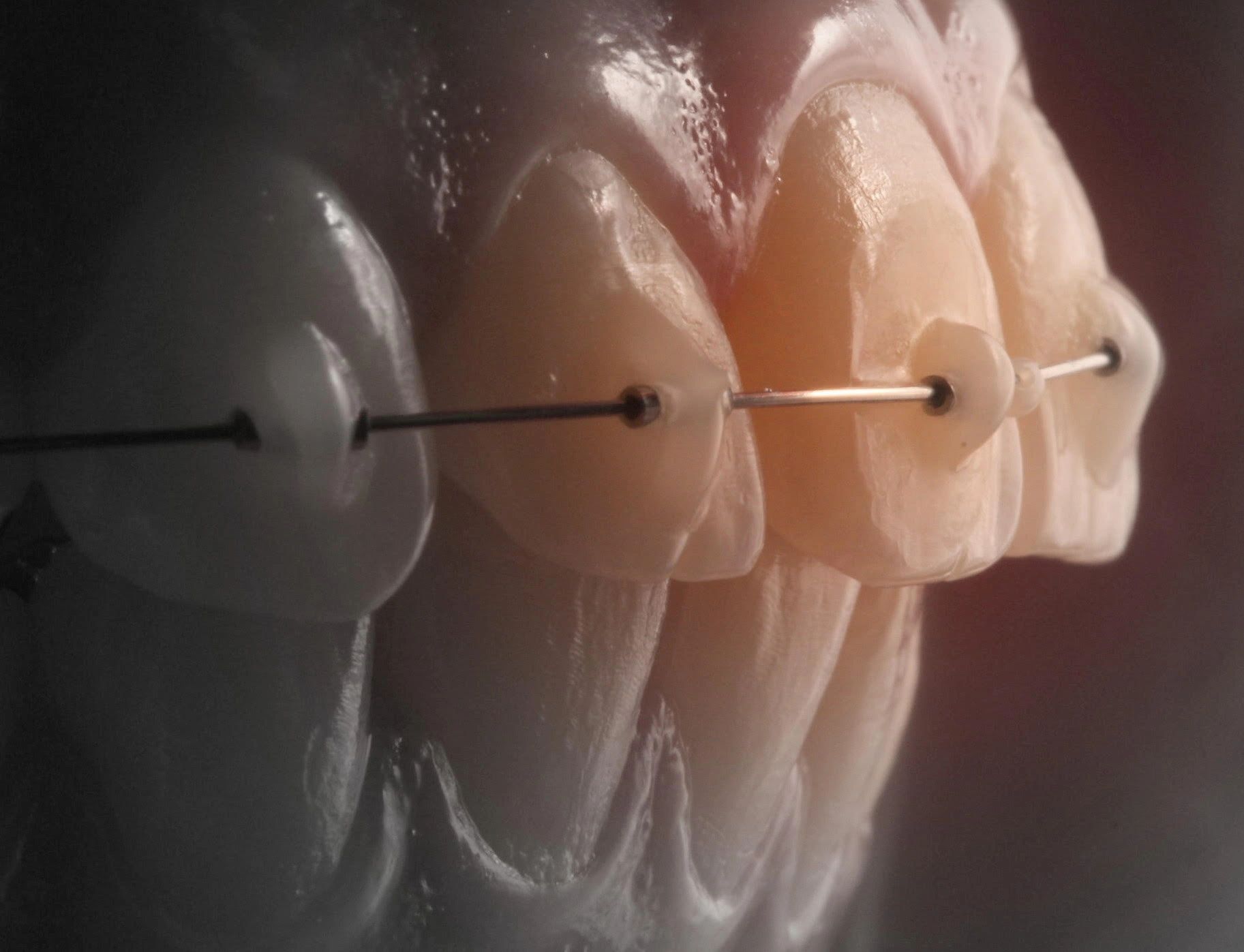 Conoce el novedoso sistema de Ortodoncia Flow Jac System-