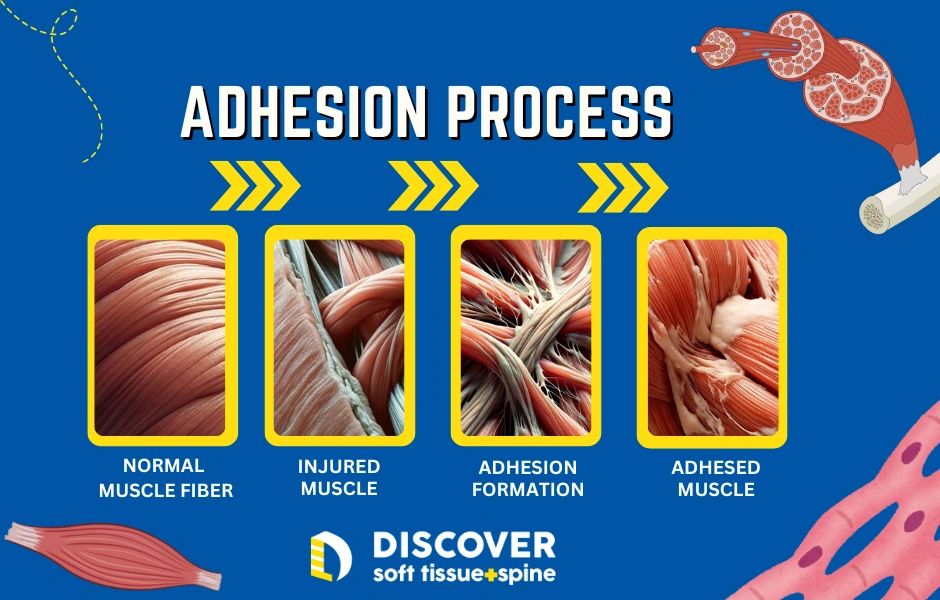Understanding Muscle Adhesions: Causes and Effects on Your Body