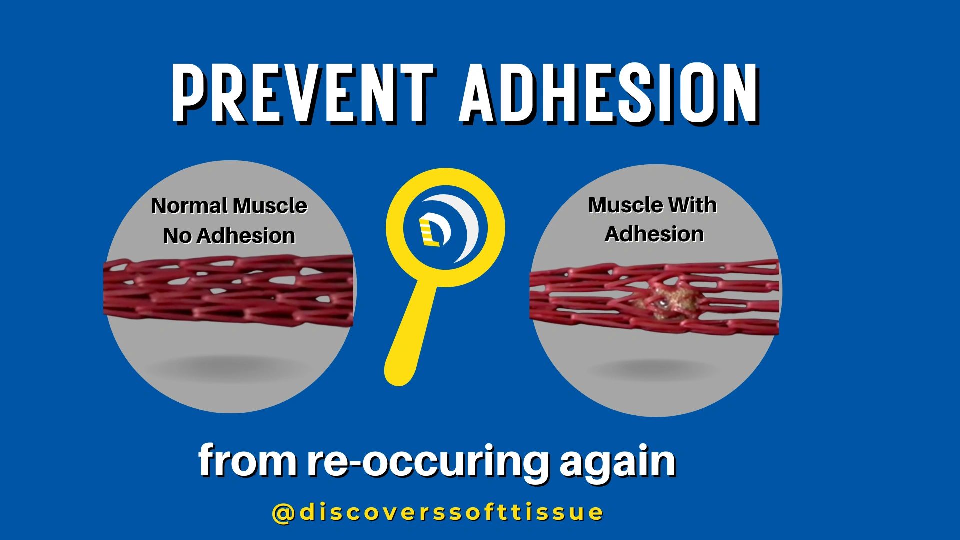 ️ 5 POWERFUL WAYS TO AVOID FIBROUS ADHESION COMEBACK! ️