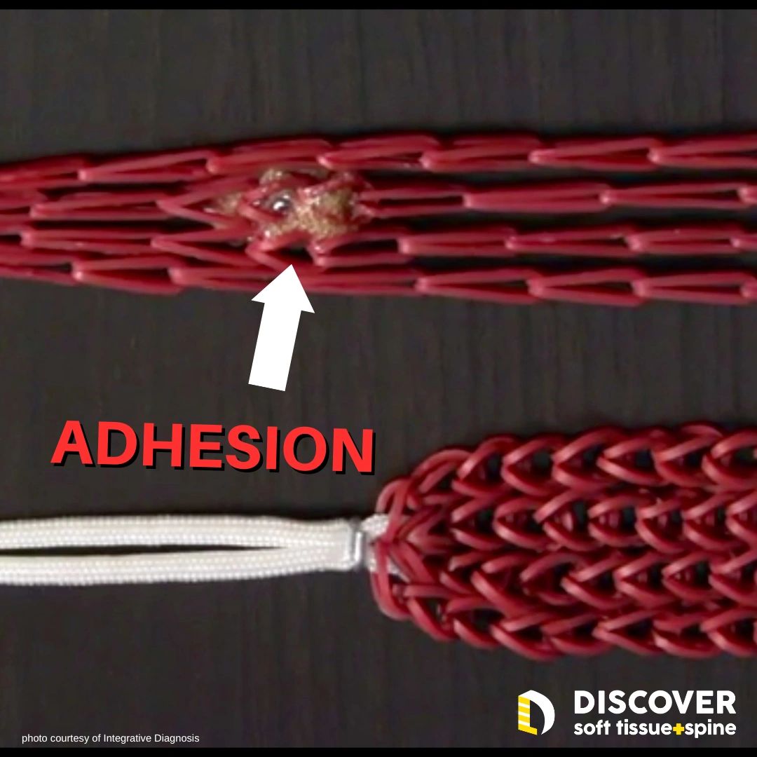 Tightness and stiffness could be signs of having adhesion