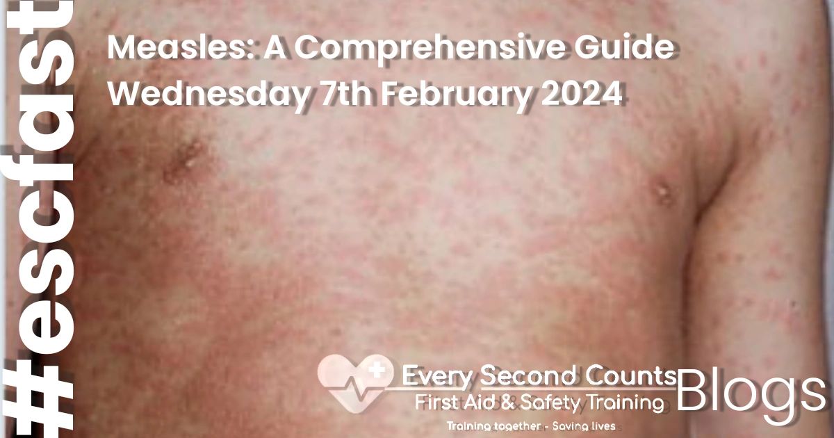 Measles: A Comprehensive Guide
