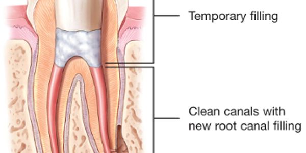 East End Endodontics - Endodontics, Root Canals