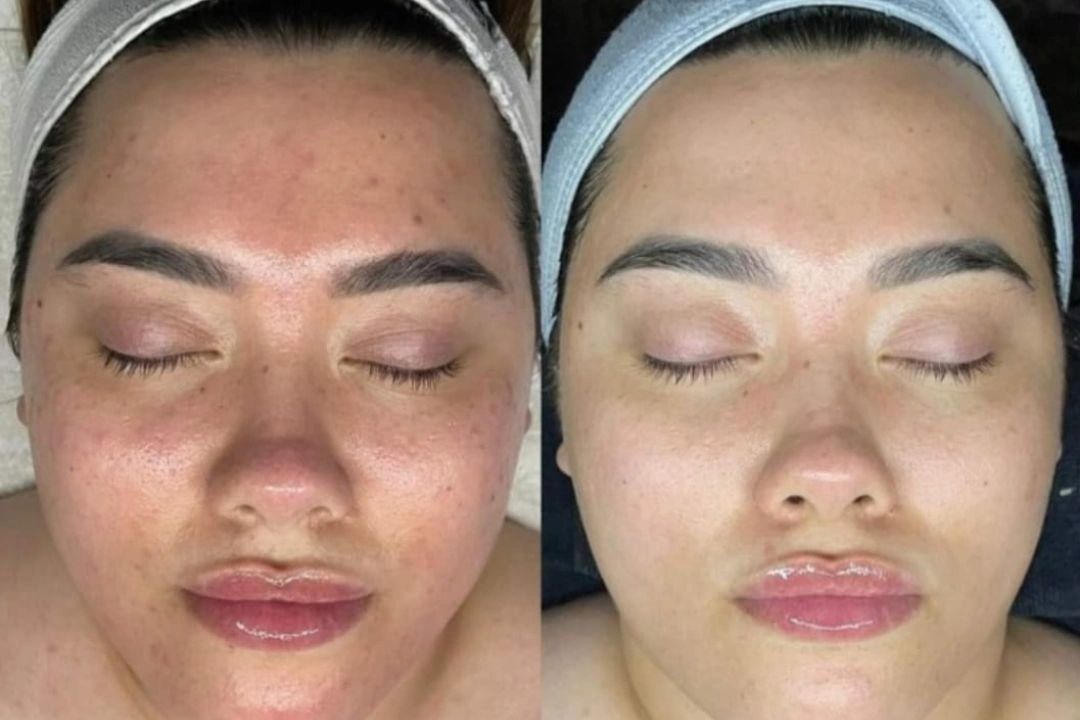 How DMK Enzyme Therapy Promotes Resilient Skin at Any Age