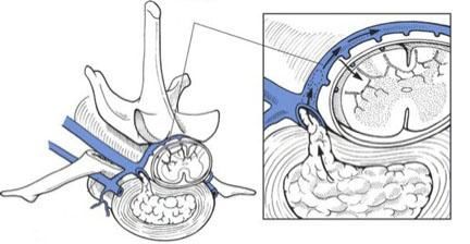 What Is A Spinal Stroke In A Dog