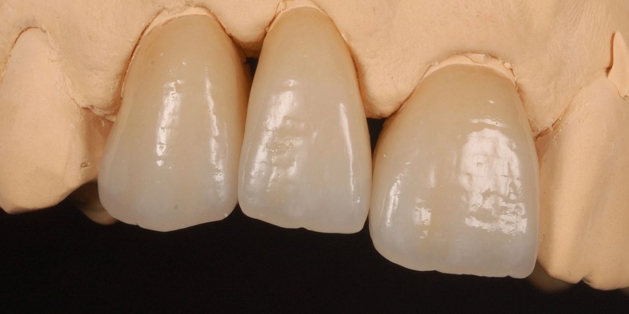 Dental Effects - Dental Laboratory, Crowns, Implants