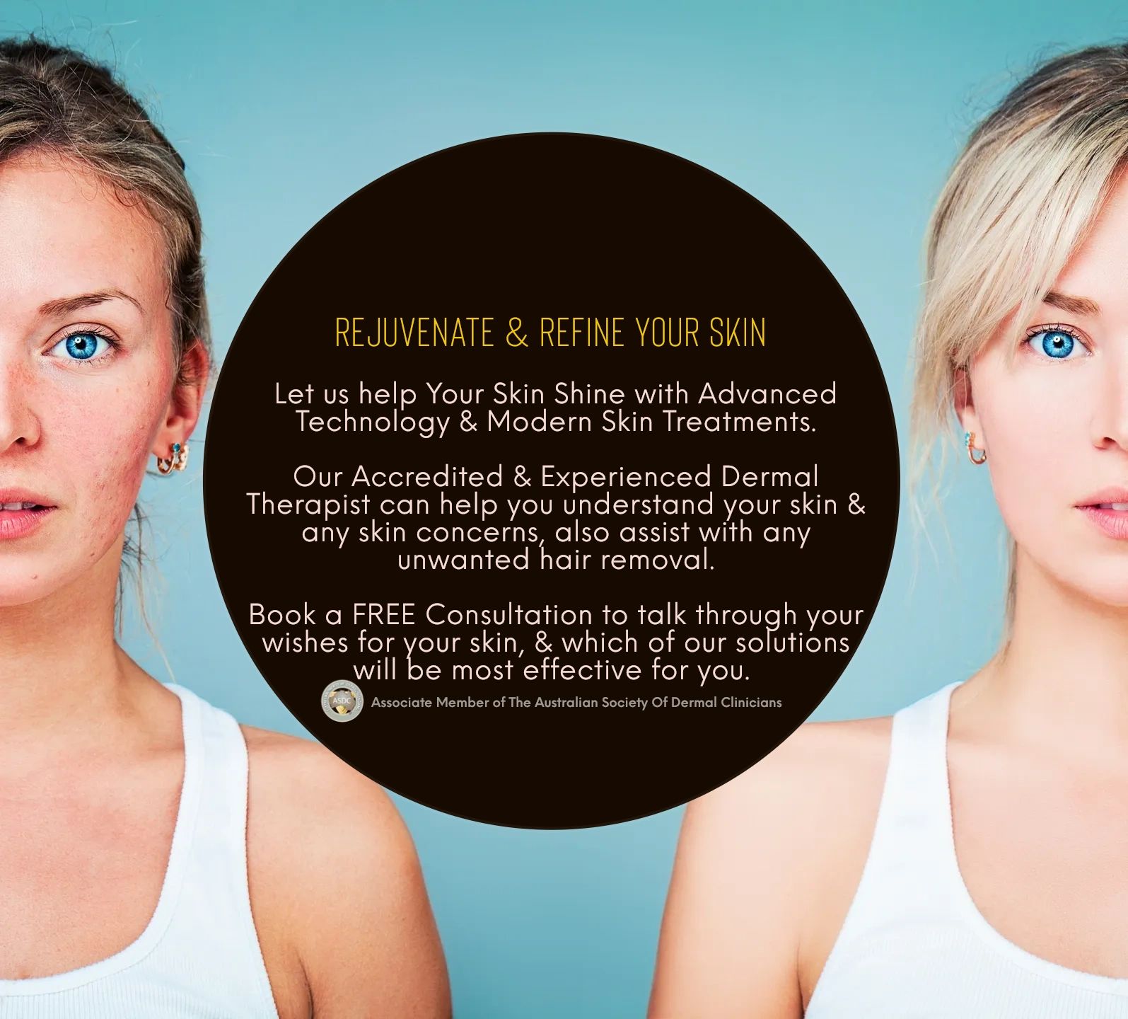 Laser Resurfacing, Acne Skin Laser Treatment, Skin Laser - Skin Shine ...