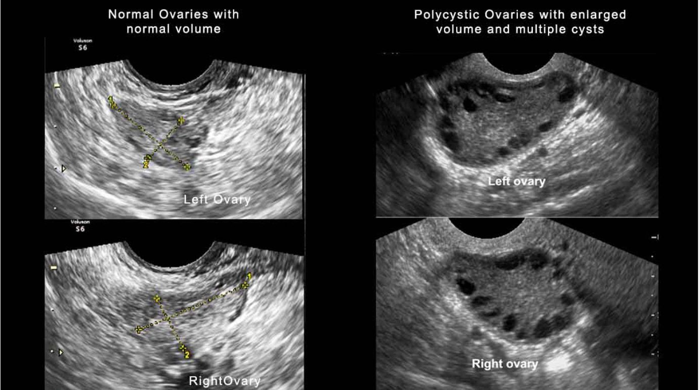 Normal Vs Polycystic Ovaries Ultrasound