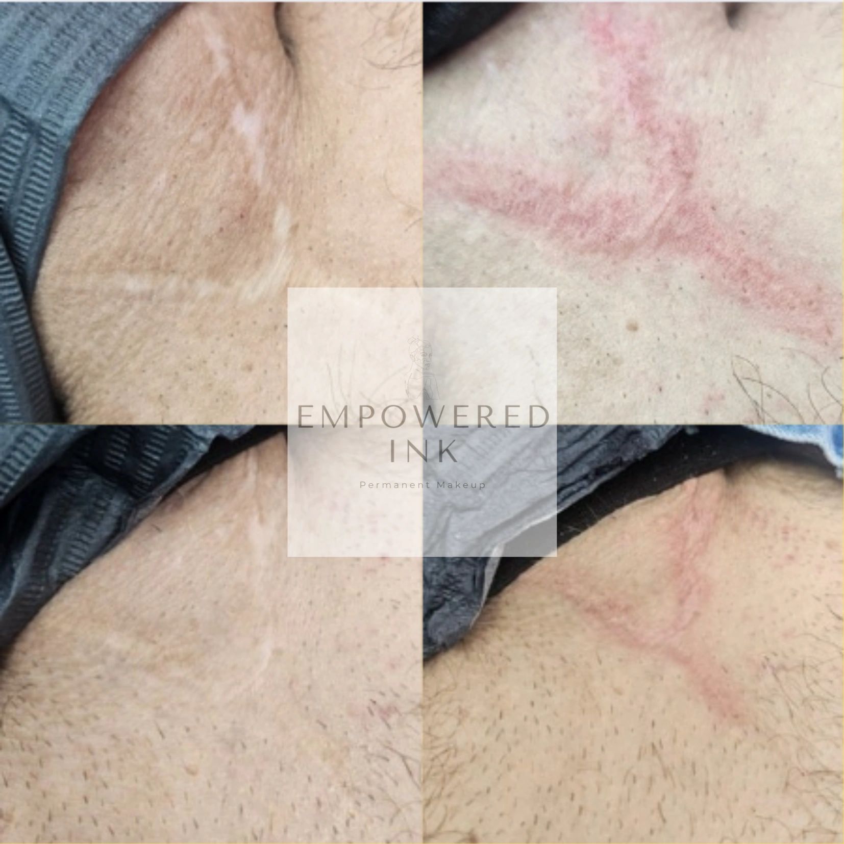 Understanding Scar Maturity Before Paramedical Tattooing