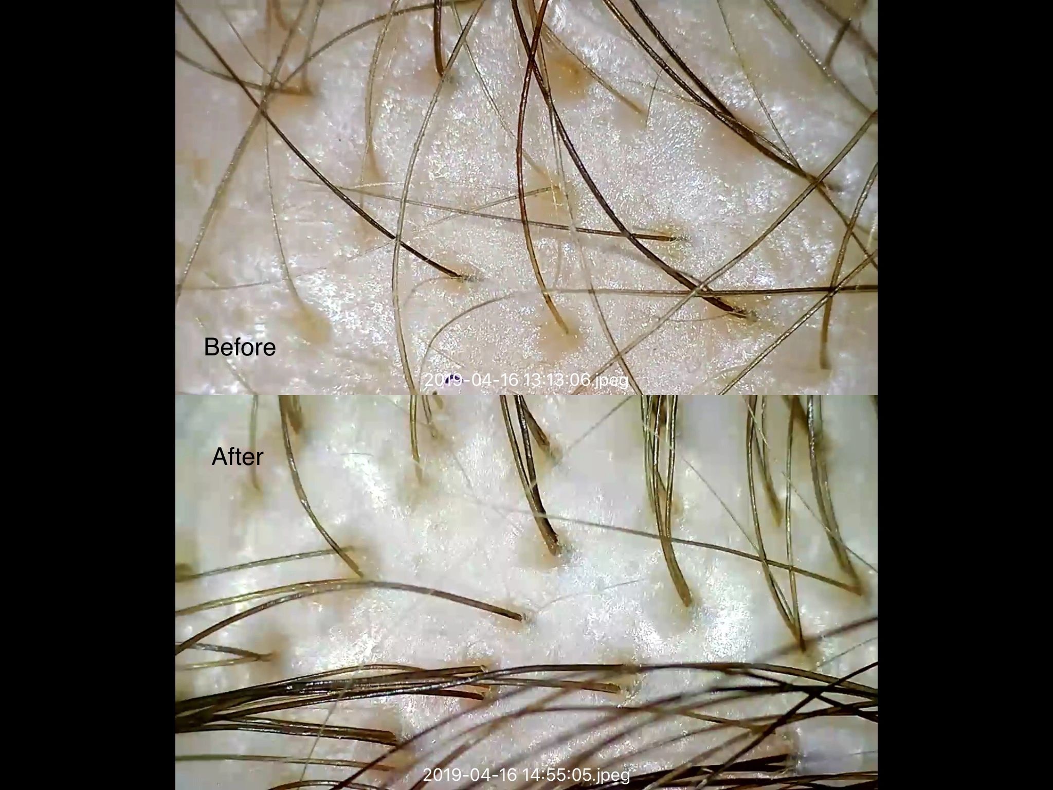 Sebum On Hair Roots