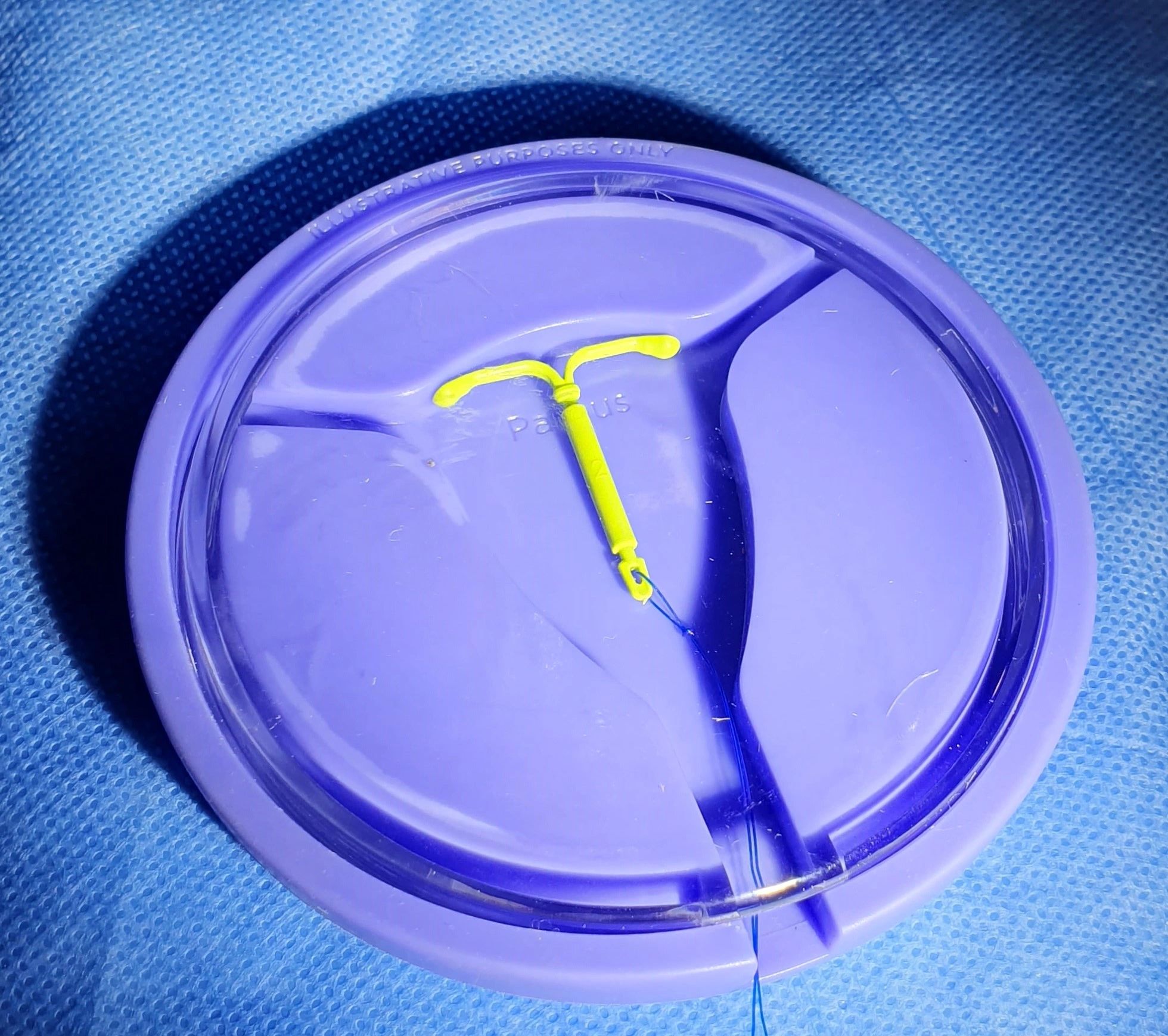 All about the 19.5mg Levonorgestrel (Kyleena®) IUD