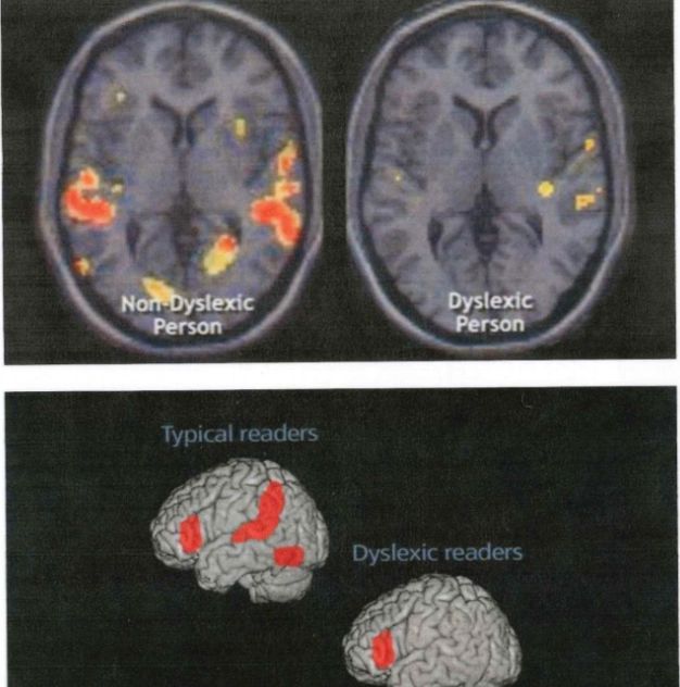 The Anatomy of Dyslexia