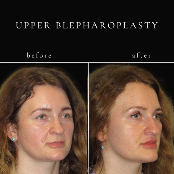 Bleph gallery | The Stella Center