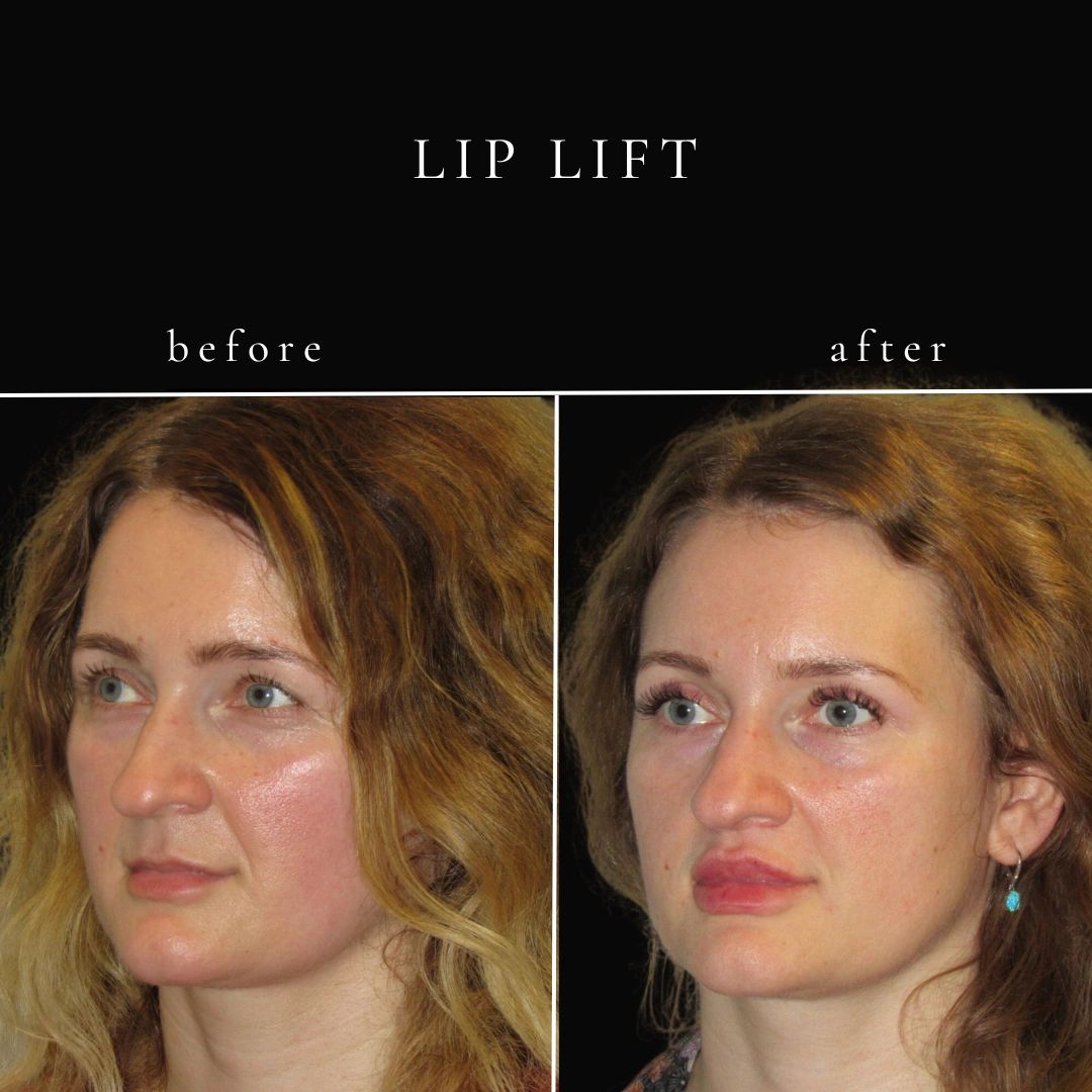 Lip Lift Gallery