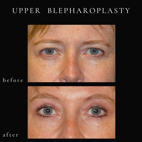 Bleph gallery | The Stella Center