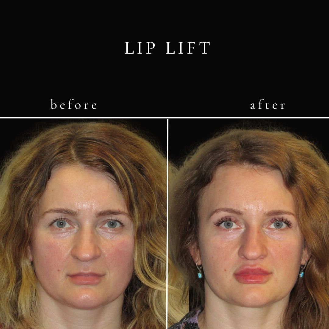 Lip Lift Gallery