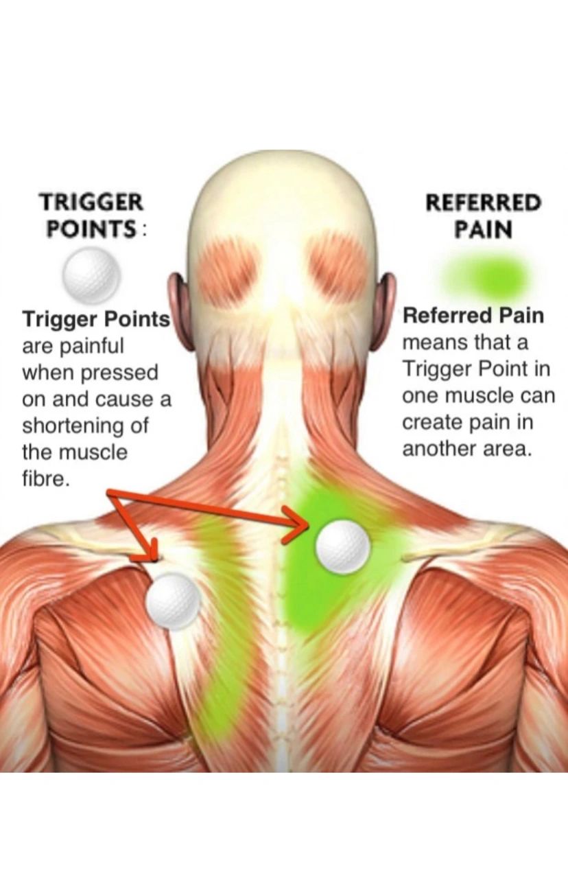 Trigger Point Therapy