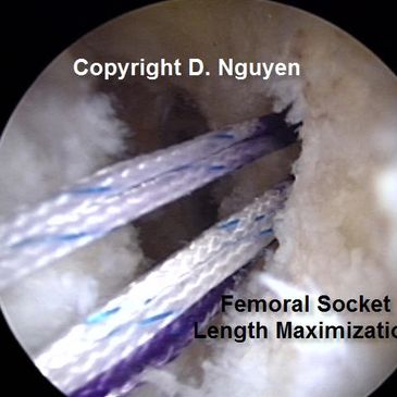 ACL Surgery | Nguyen Sports Medicine