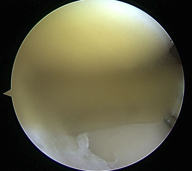 Meniscus Surgery | Nguyen Sports Medicine