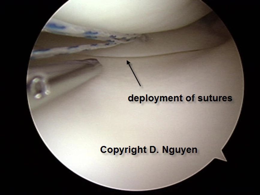 Meniscus Surgery | Nguyen Sports Medicine