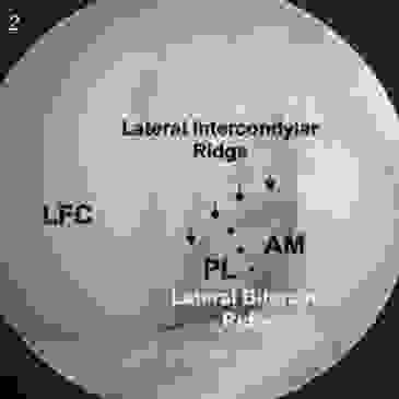 ACL Surgery | Nguyen Sports Medicine
