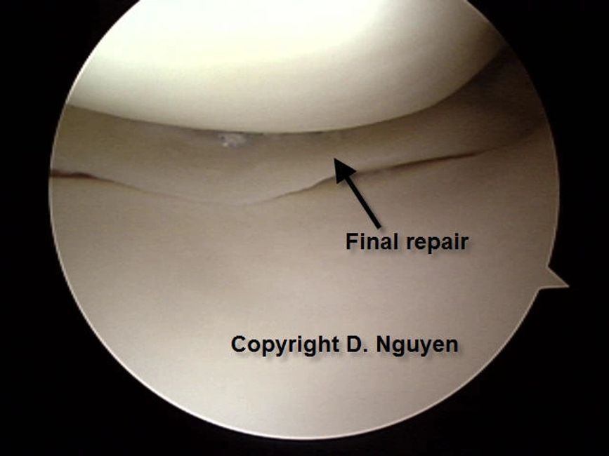 Meniscus Surgery | Nguyen Sports Medicine