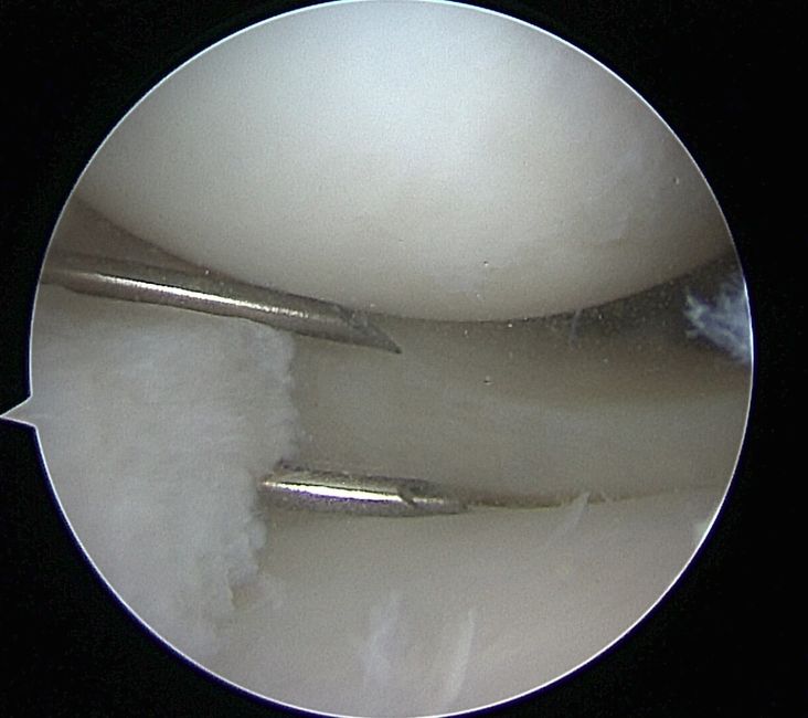 Meniscus Surgery | Nguyen Sports Medicine