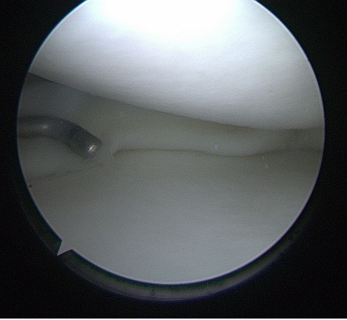 Meniscus Surgery | Nguyen Sports Medicine